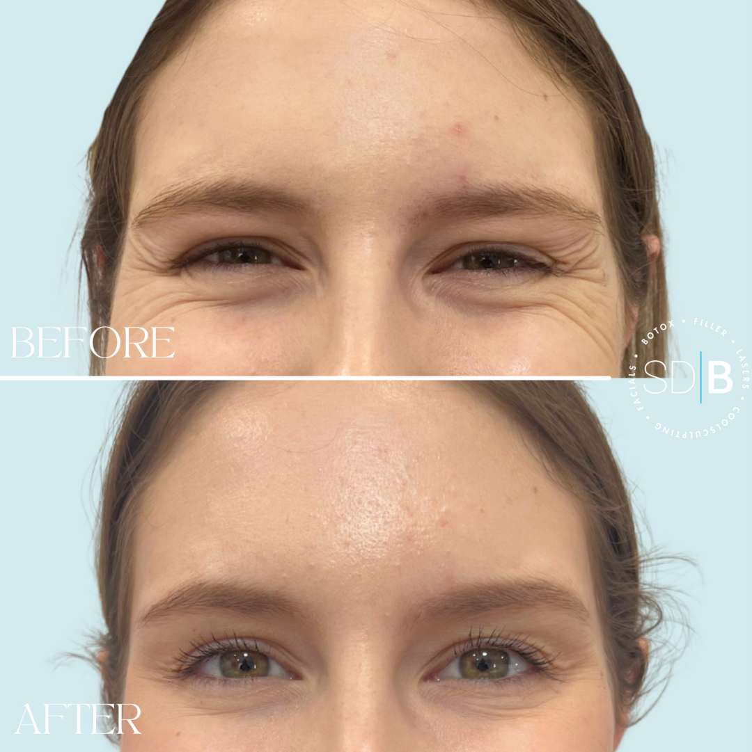 Botox for Crow's Feet: SDBotox Austin Treatment | 2025
